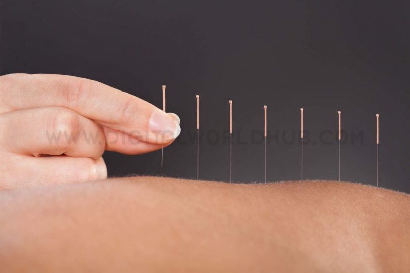 Acupuncture Facts And Its Uses | Digital World Hub